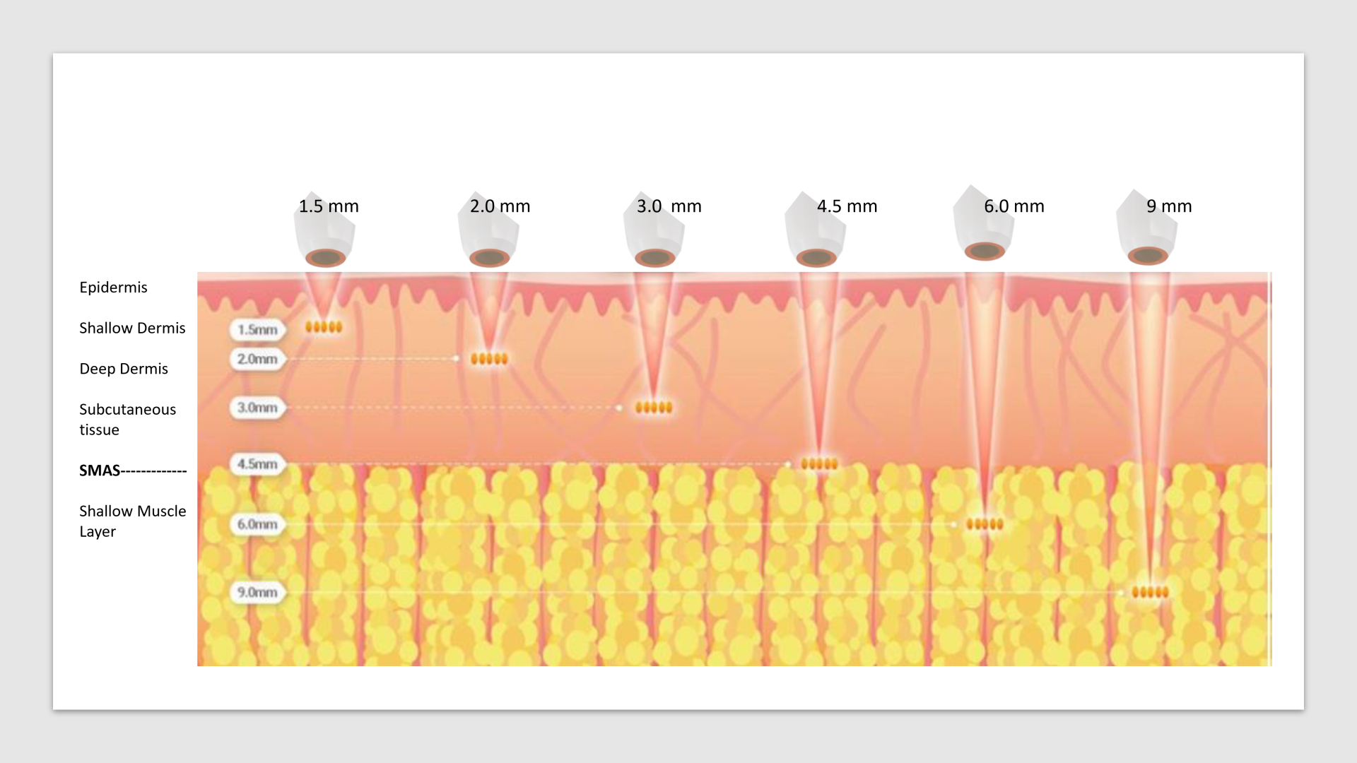 HIFU | High Intensity Focused Ultrasound